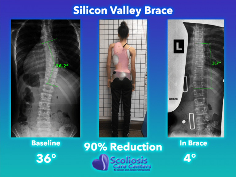 Silicon Valley Scoliosis Back Brace Scoliosis Care Centers