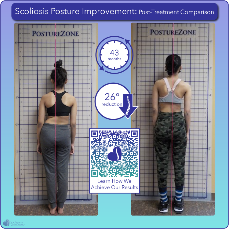 Scoliosis Posture Results - Scoliosis Care Centers