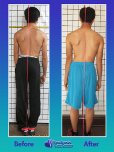 Scoliosis Posture Results - Scoliosis Care Centers