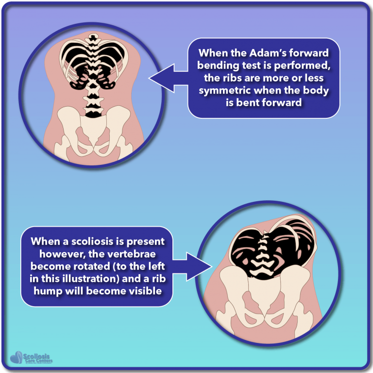 Nerve Tension and Scoliosis - Scoliosis Care Centers