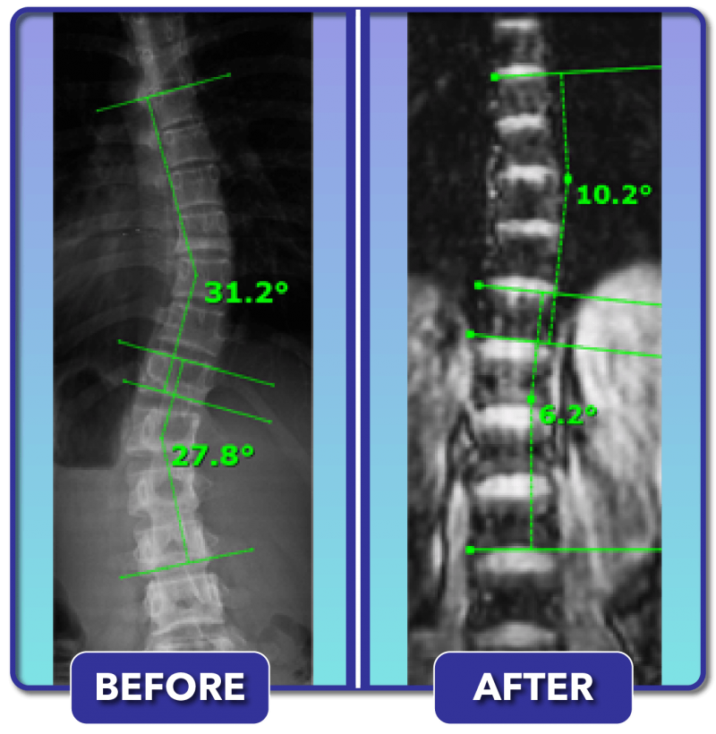 Scoliosis Treatment for Children and Teens - Scoliosis Care Centers