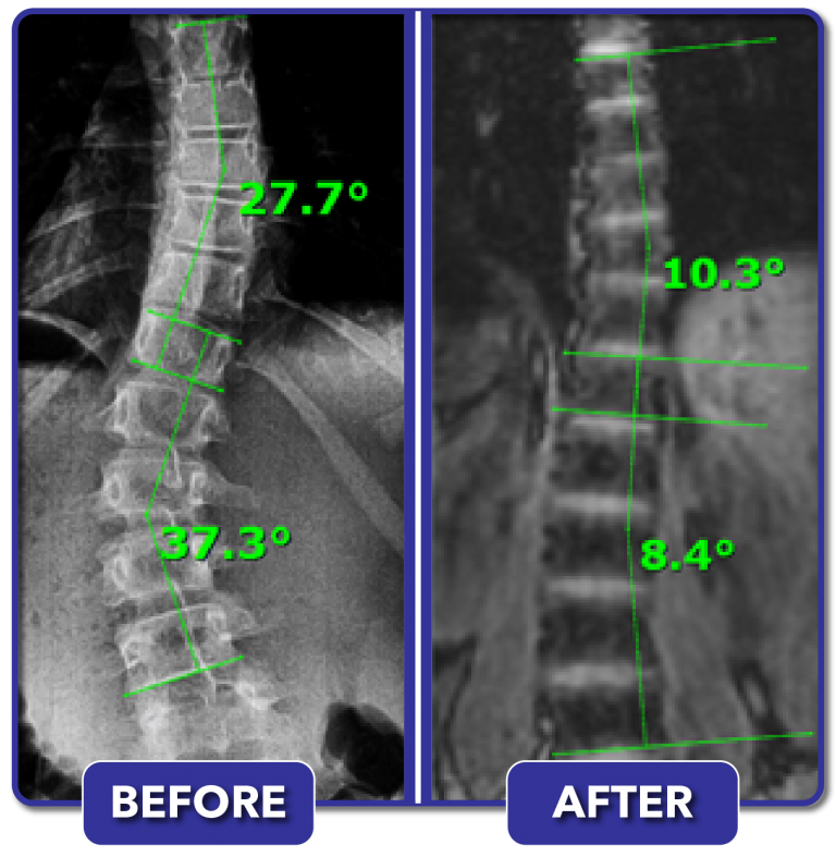 Scoliosis Treatment for Children and Teens - Scoliosis Care Centers