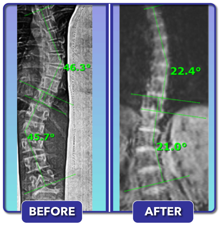 Scoliosis Before And After Treatment Results Scoliosis Care Centers