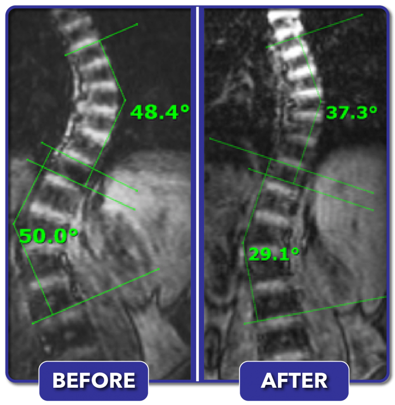 Scoliosis Before And After Treatment Results Scoliosis Care Centers