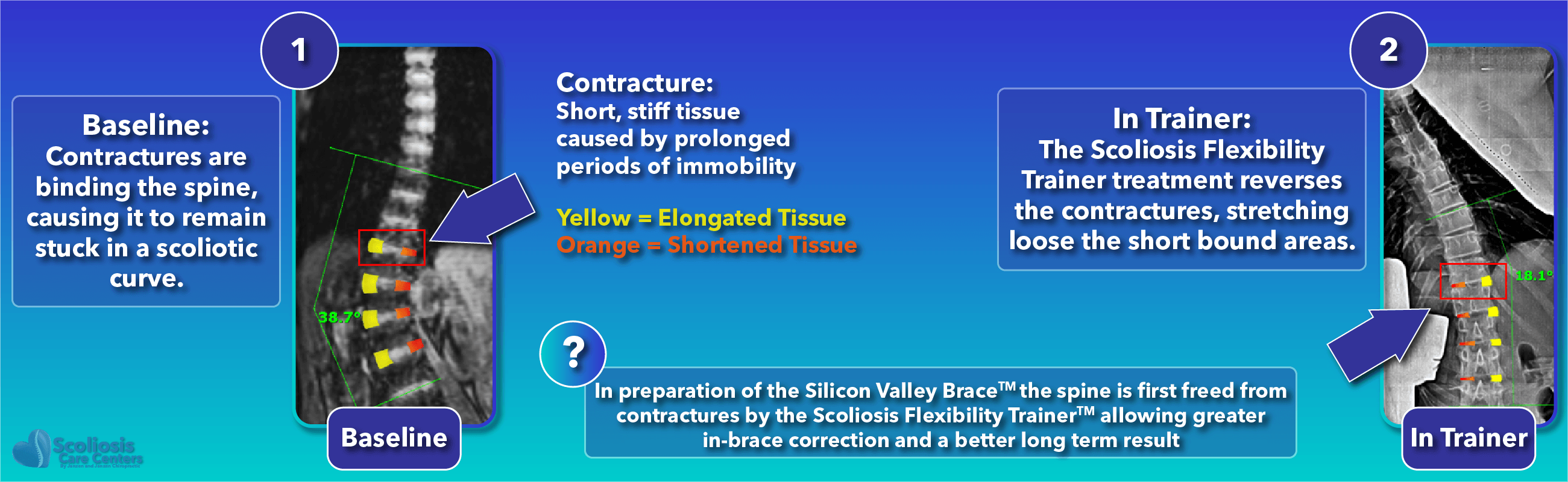 Scoliosis Flexibility Trainer - Straighten Spines Without Surgery