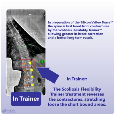 Scoliosis Flexibility Trainer - Straighten Spines Without Surgery