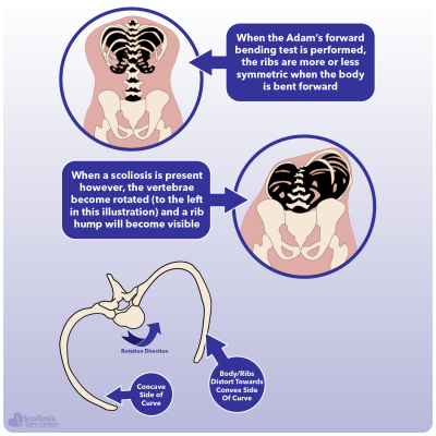 Mild Scoliosis: What it is and what to do about it - Scoliosis Care Centers