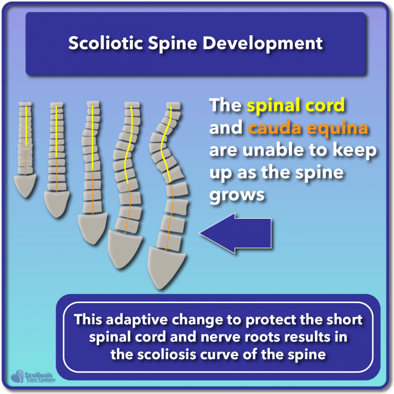 What is Scoliosis? Scoliosis Defined & Its Causes - Scoliosis Care Centers