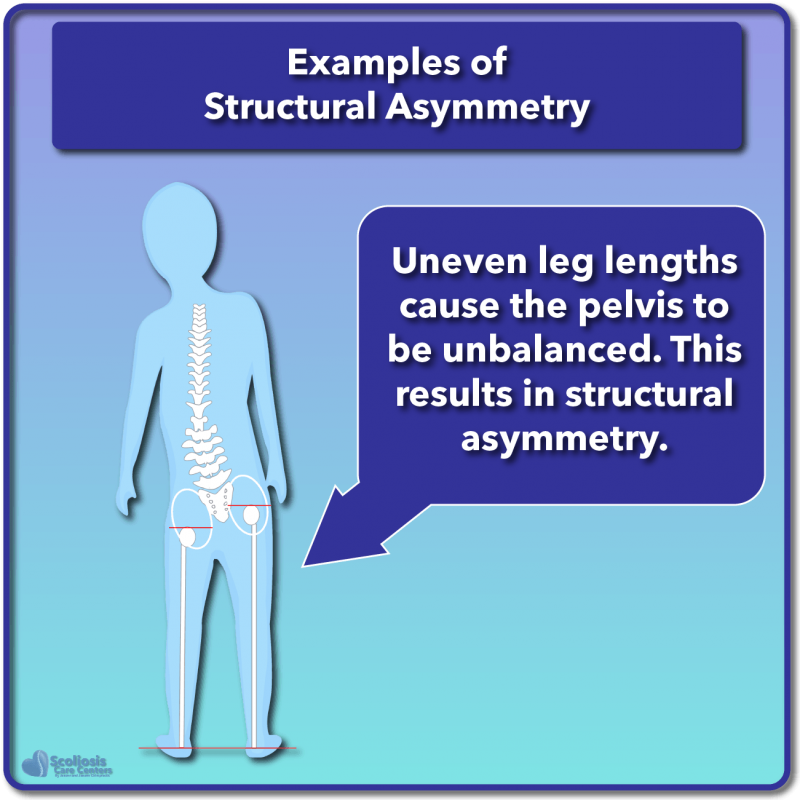 What is Scoliosis? Scoliosis Defined & Its Causes - Scoliosis Care Centers
