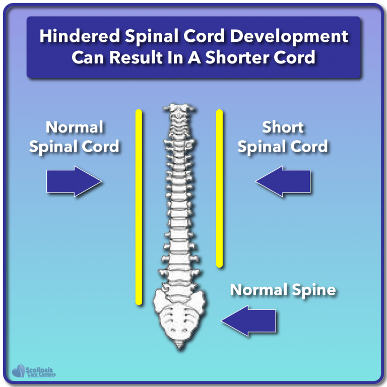 Autism and Scoliosis: Is There a Connection? - Scoliosis Care Centers