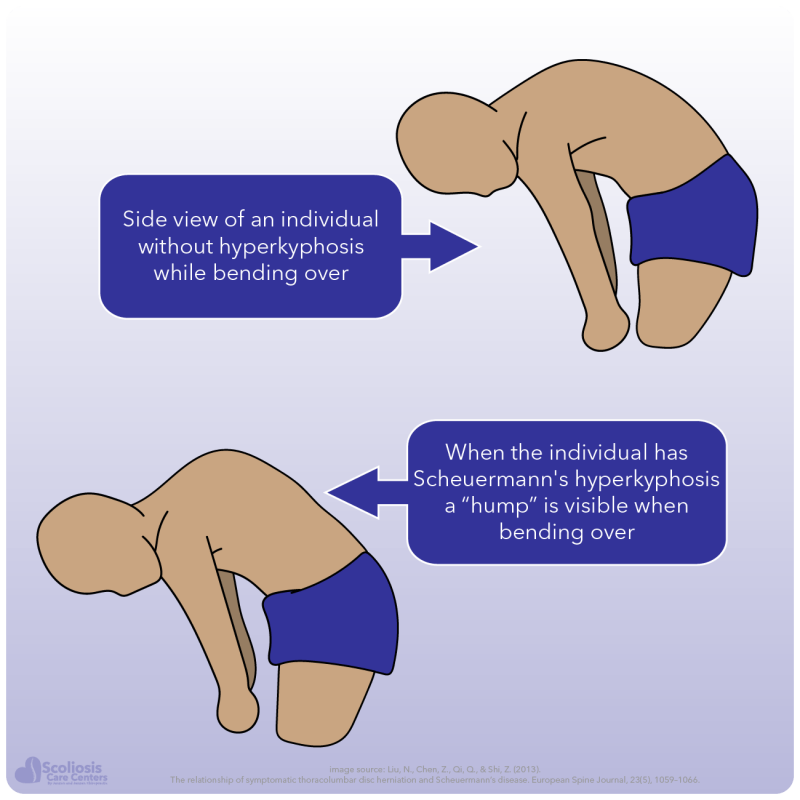 Kyphosis and Hyperkyphosis - What it is, how it happens, and what to do