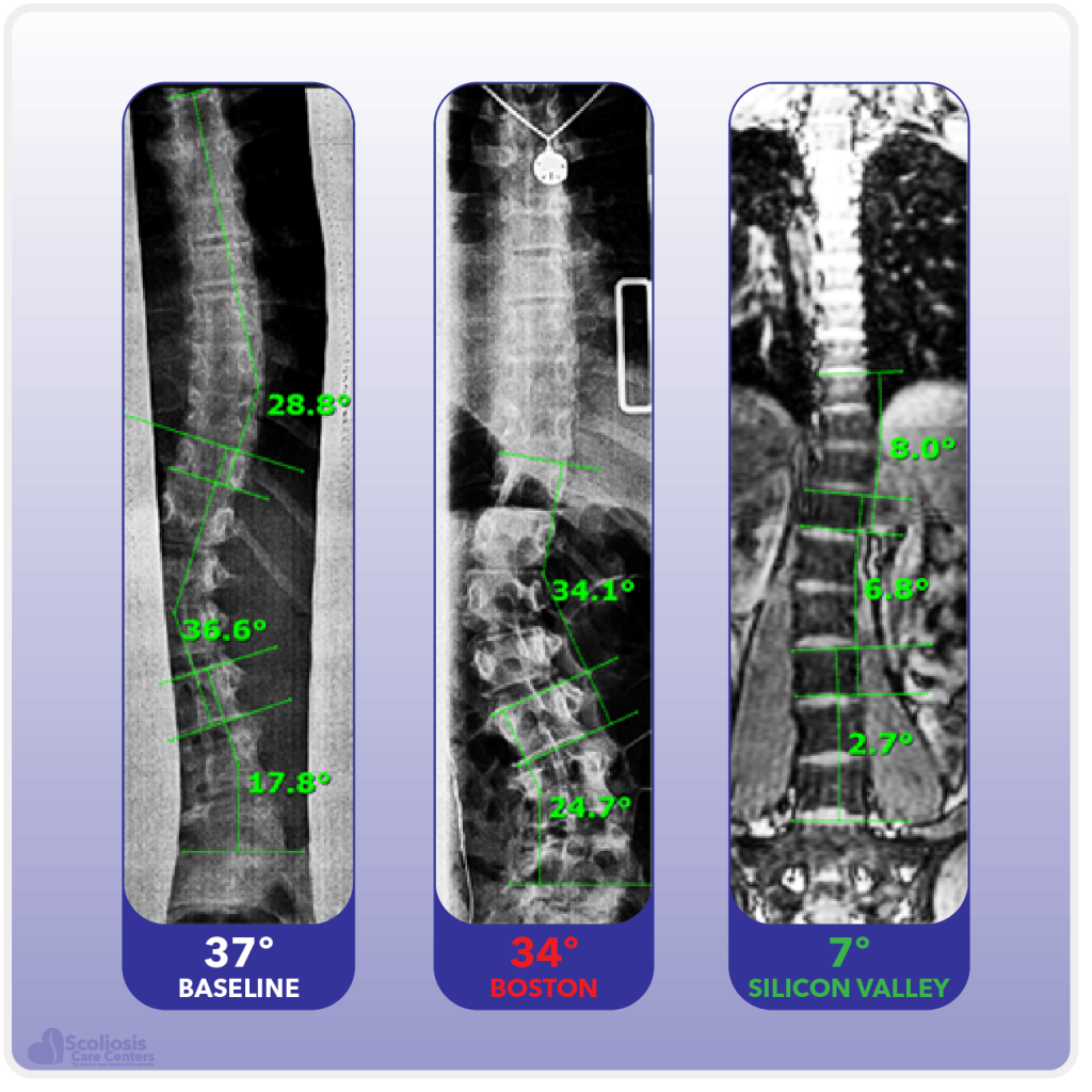 Silicon Valley Scoliosis Method: Effective Treatment Without Surgery Silicon Valley Scoliosis Method: Effective Treatment Without Surgery