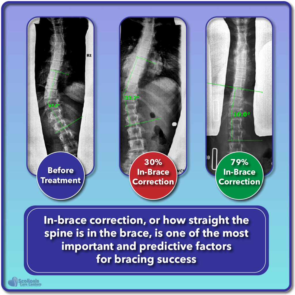 Is Bracing For Scoliosis Effective Fact Check Scoliosis Care Centers