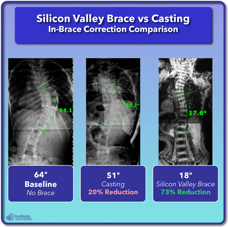 Scoliosis Treatment for Children and Teens - Scoliosis Care Centers