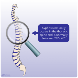 Kyphosis and Hyperkyphosis - What it is, how it happens, and what to do