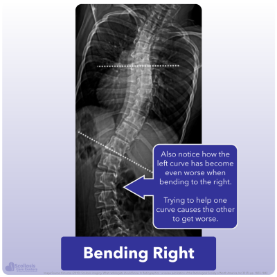 Scoliosis Flexibility Trainer - Straighten Spines Without Surgery