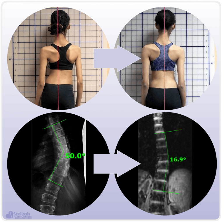 Silicon Valley Scoliosis Method: Effective Treatment Without Surgery Silicon Valley Scoliosis Method: Effective Treatment Without Surgery