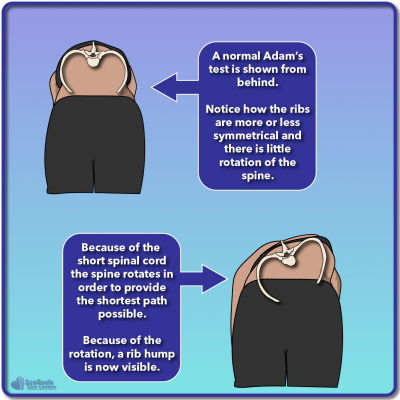 Scoliosis Rib Hump Results - Scoliosis Care Centers