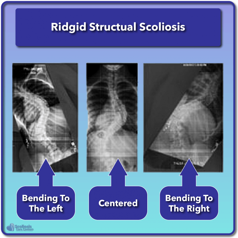 What is Scoliosis? Scoliosis Defined & Its Causes - Scoliosis Care Centers