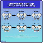 Scoliosis Treatment for Children and Teens - Scoliosis Care Centers