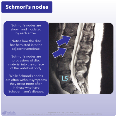Kyphosis and Hyperkyphosis - What it is, how it happens, and what to do