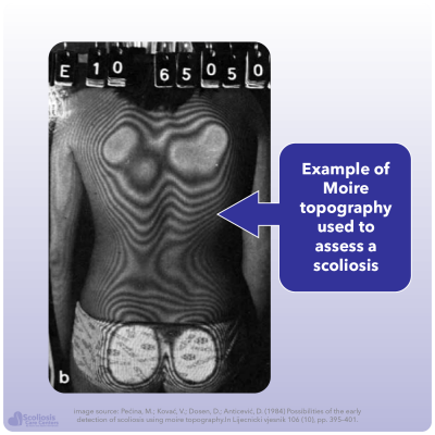 Mild Scoliosis: What it is and what to do about it - Scoliosis Care Centers