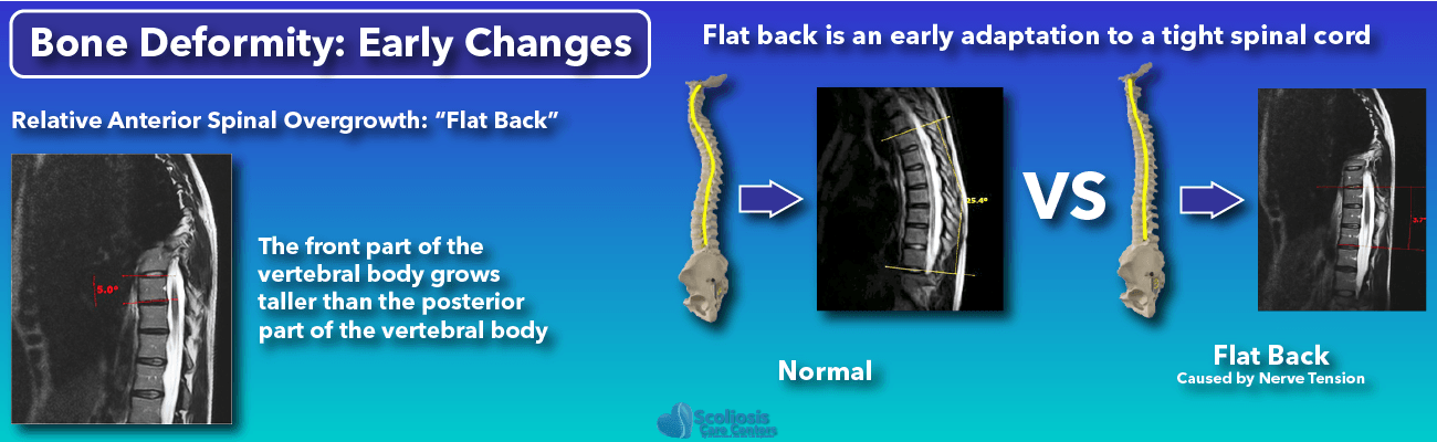 What is Scoliosis? Scoliosis Defined & Its Causes - Scoliosis Care Centers