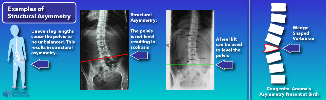 What is Scoliosis? Scoliosis Defined & Its Causes - Scoliosis Care Centers