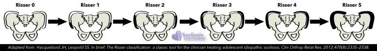 Risser Signs, Skeletal Age, and Scoliosis: How are they related?